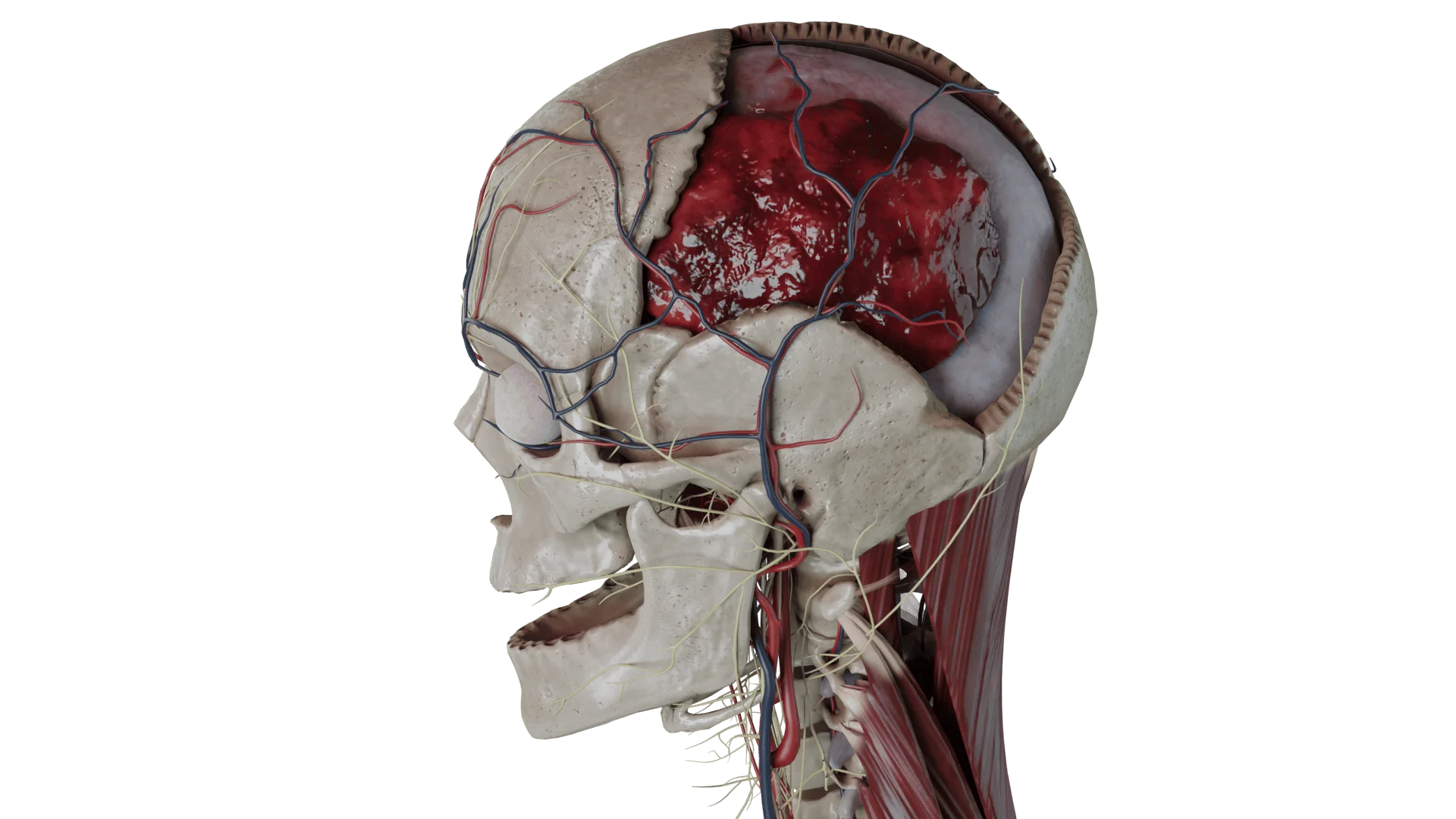3D Model of Subdural Hemorrhage | VOKA
